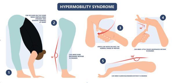 Hypermobility Syndrome & Back Pain Explained
